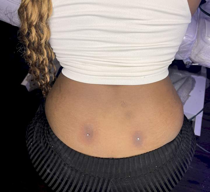 Dimples Piercing Taken Out