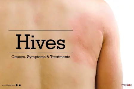 What do Hives look like? Symptoms and Treatment