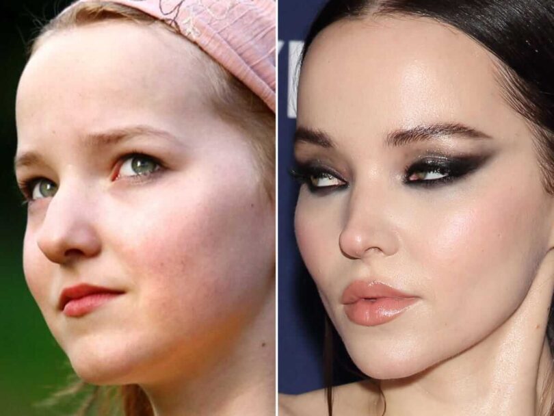 Dove Cameron Plastic Surgery: The Disney Star's Aesthetic Choices ...